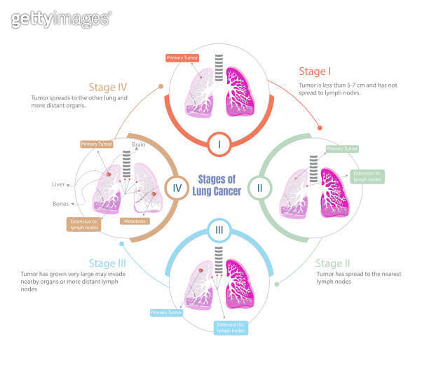 Stages of lung cancer. Process of how it progresses in all its stages ...