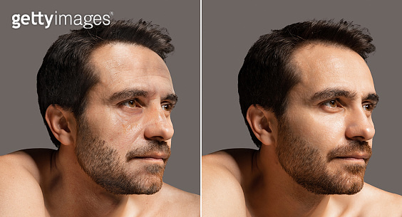 Collage of two portraits of mature man before and after rejuvenation ...