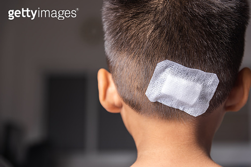 The lacerated suture wound of kid back head which suture with trauma ...
