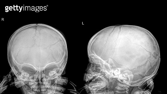 skull x-ray with a linear fracture of a left parietal bone. 이미지 ...
