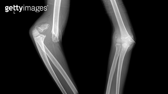 radiography of a child elbow with a humerus fracture. 이미지 (1387275970 ...