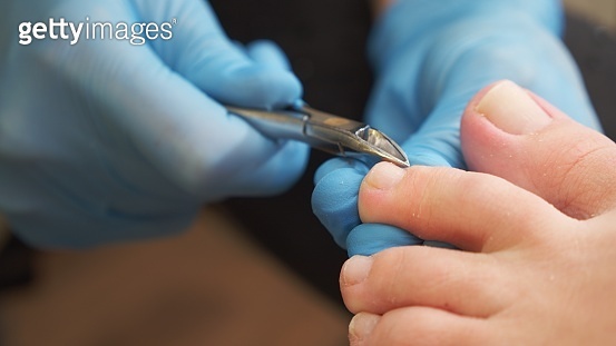 Processing of rough cuticles of nails on leg with a nail nipper. Nails ...