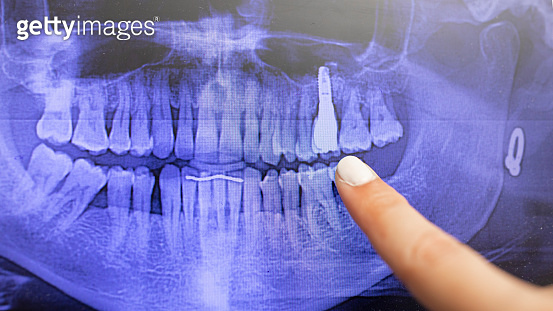 Detail of a digital dental panoramic radiograph, taken with x-ray, of a ...