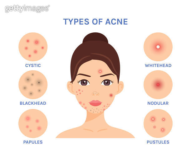 Isolated Pretty Brunette Woman with Problem Skin on Face. Teenager with ...