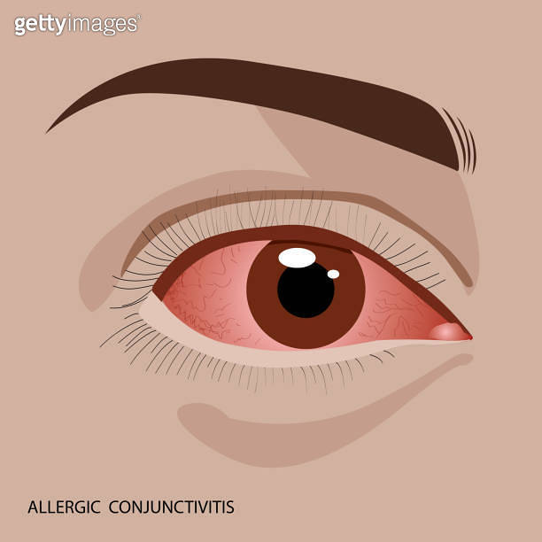 Allergic, conjunctivitis, red eyes, infection and inflammation, close ...