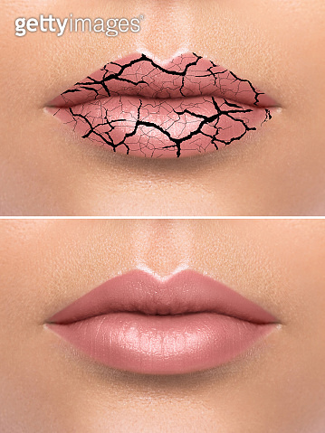 Chapped female lips after treatment 이미지 (1373151162) - 게티이미지뱅크