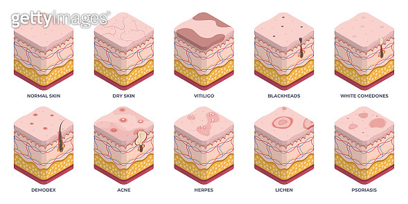 Isometric human skin types, 3d epidermis layers. Dermatology normal ...