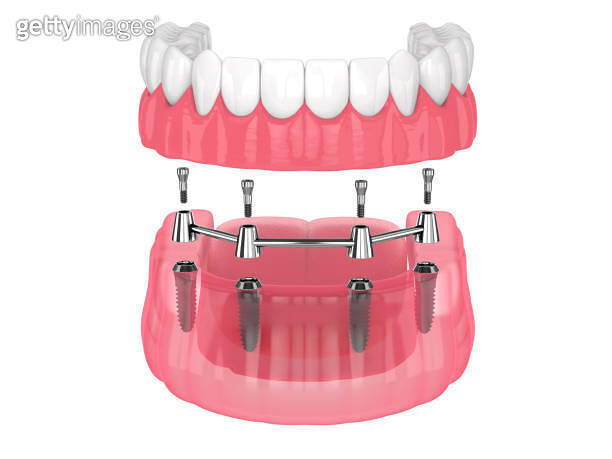 Removable overdenture installation on bar clip attachment, supported by ...