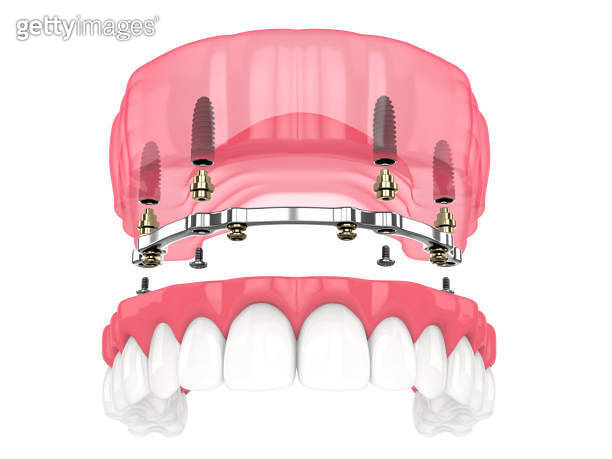 Bar retained removable overdenture installation supported by implants ...