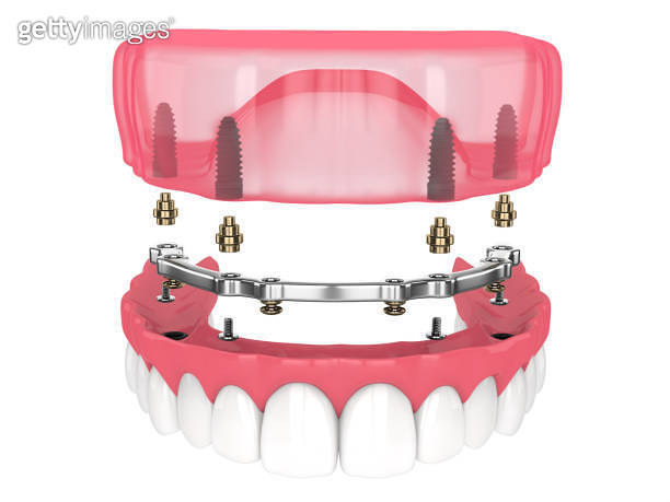 Bar retained removable overdenture installation supported by implants ...