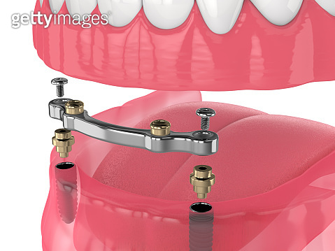 3d render of bar retained removable overdenture installation supported ...