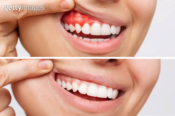 Cropped shot of a young woman with red bleeding gums and health gums ...