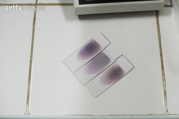 Blood smear on slide glass in hematology laboratory. (1389237126) - 게티이미지뱅크