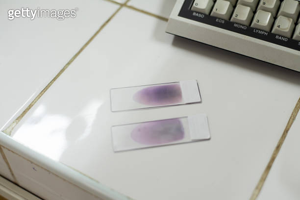 Blood smear on slide glass in hematology laboratory. (1389237117) - 게티이미지뱅크
