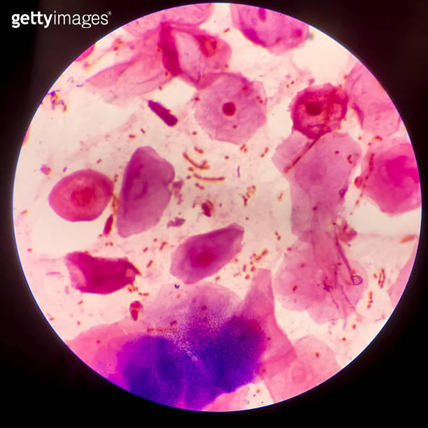 Bacteria cell Gram neagative bacilli with capsule.Sample sputum in Gram ...