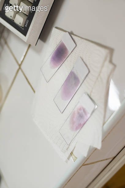 Blood smear on slide glass in hematology laboratory. 이미지 (1389237118 ...