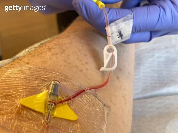 Gloved hand of nurse flushing intravenous tubing after medication ...