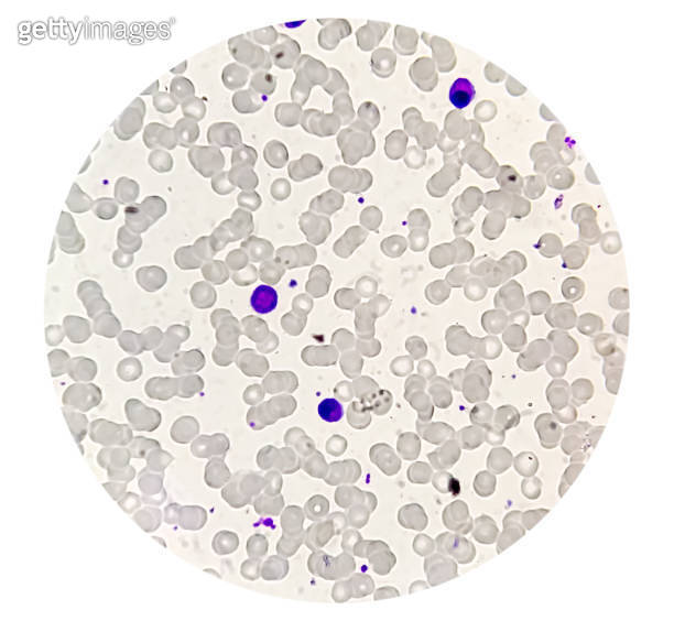 Reactive Lymphocytes analized by microscope. 이미지 (1369249738) - 게티이미지뱅크