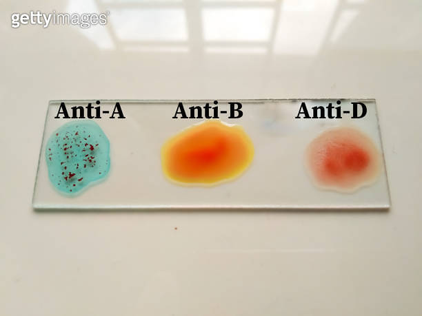 Blood group testing by slide agglutination method. 이미지 (1418476757 ...