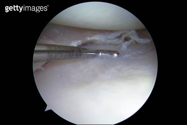 Arthroscopic view of knee with osteoarthritis and degenerative meniscal ...