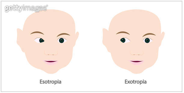 Strabismus type illustration. Esotropia and Exotropia ilustration in a ...