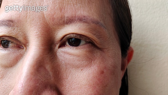 The flabbiness adipose sagging skin, forehead lines, swelling and bag under the eyes. 이미지 ...