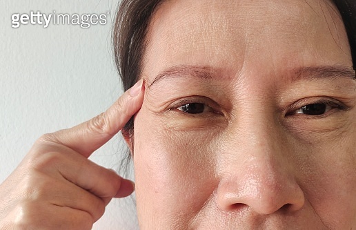 The flabbiness adipose sagging skin, cellulite and flabby skin on the ...