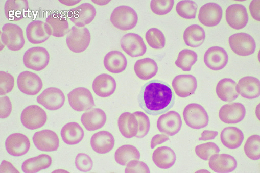Target cells with abnormal red blood cells in blood smear 이미지 ...