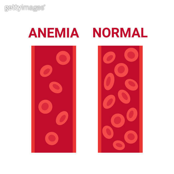 Normal and anemia blood in vessel comparison, number circulation cells ...
