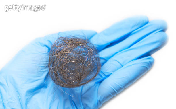 Ball of hair on a doctors's hand. Hair loss, health concept ...