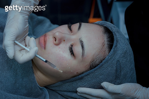 Needle mesotherapy. Microneedle meso therapy, treatment woman at the ...