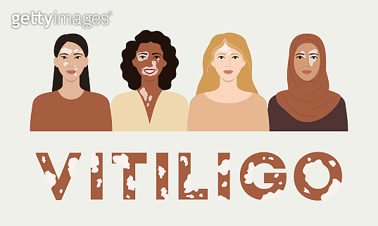 Female faces with vitiligo skin disease banner. World vitiligo day ...