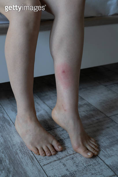 Asian female touches her leg after being bitten by mosquito at home ...