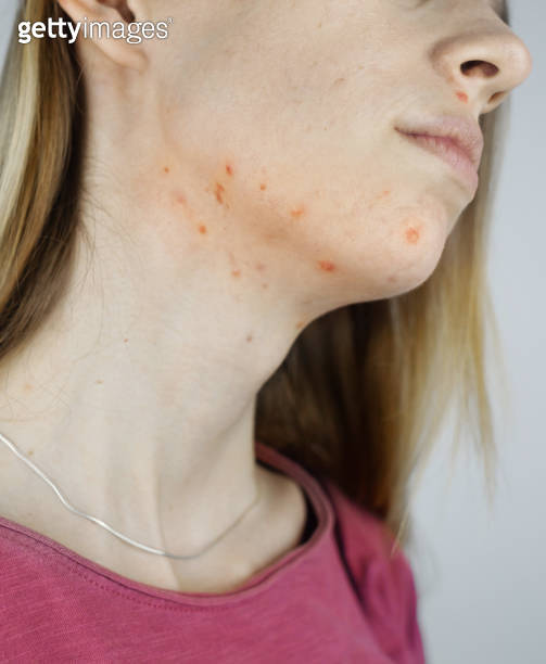 Girl shows acne on her face. Acne on the neck. Demodicosis on the chin ...