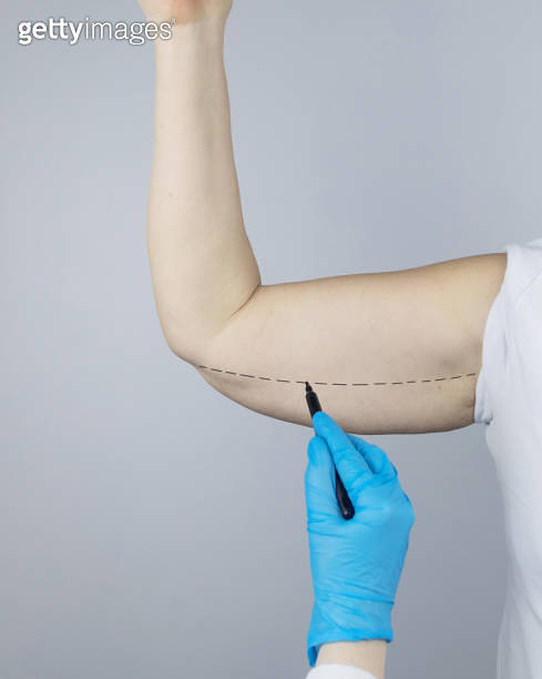 Brachioplasty. Plastic arms, dangling skin at the elbow. An older woman ...