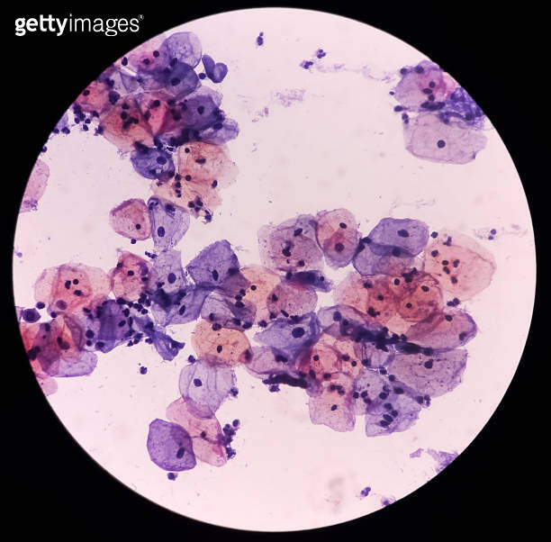 Abnormal squamous epithelial cells view in microscopy. HPV criteria for ...