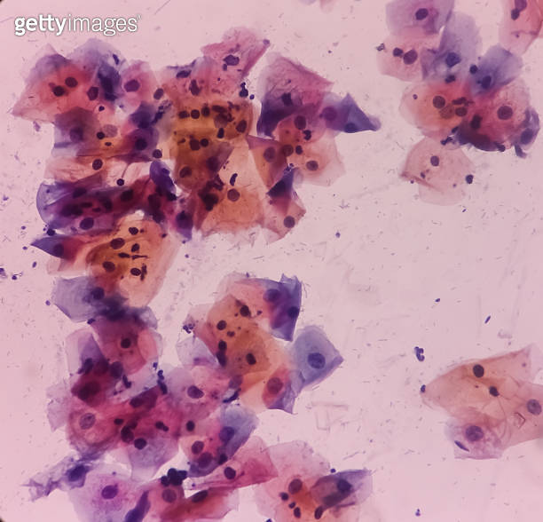 Abnormal squamous epithelial cells view in microscopy. HPV criteria for ...