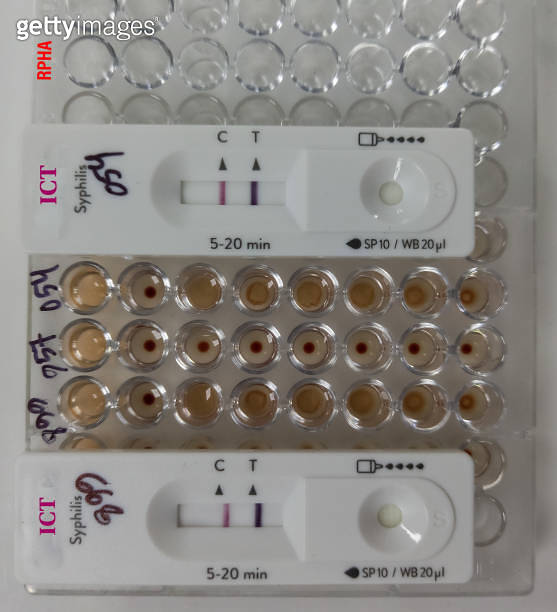 Hemagglutination assay for T. pallidum antibodies. TPHA. RPHA mathod ...