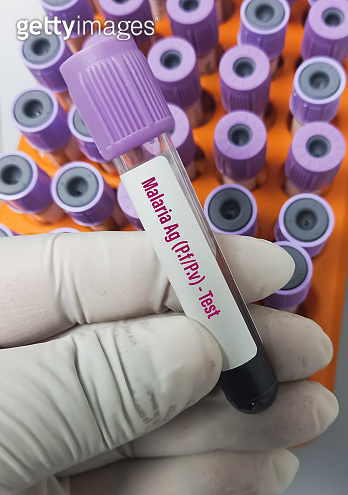 Blood test sample for Malaria Ag (Pf,Pv) test to diagnose malaria ...