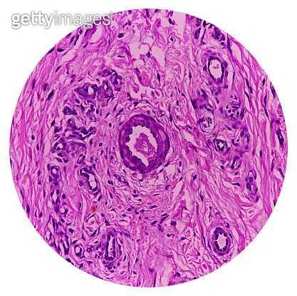 Prepatellar region histology: Chronic bursitis. light microscopic image ...