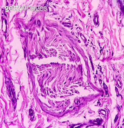 Prepatellar region histology: Chronic bursitis. light microscopic image ...