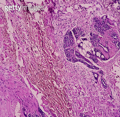 Prepatellar region histology: Chronic bursitis. light microscopic image ...