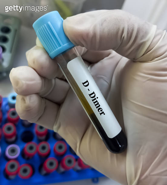 D-Dimer test. Corona patient monitoring test. deep venous thrombosis ...