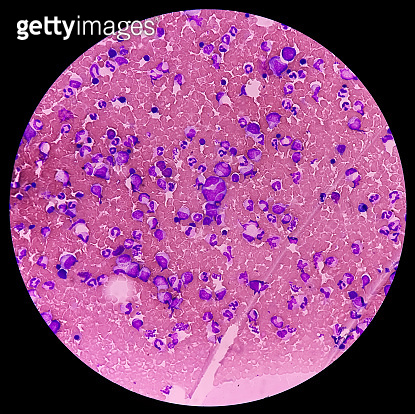 Bone marrow study: bone marrow cell with a lobated nucleus responsible ...