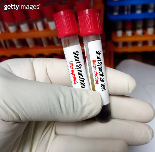 Bloods sample for short Synacthen test. Before injection and after ...