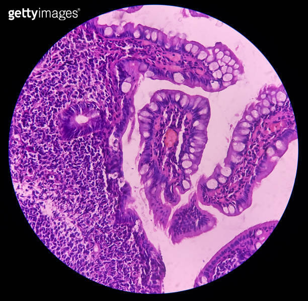 Tissue from terminal ileum: Intestinal ulcer, Chronic nonspecific ...