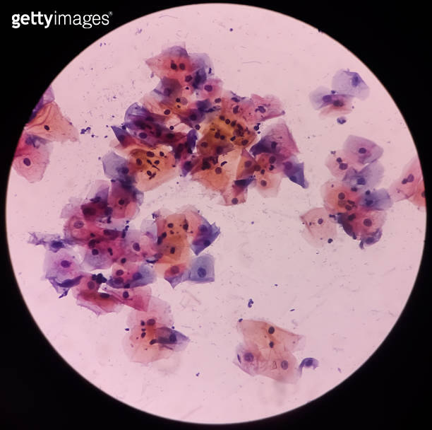 Abnormal squamous epithelial cells view in microscopy. HPV criteria for ...