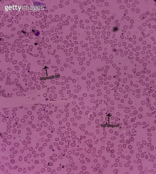 Hereditary elliptocytosis, hereditary disorder of RBCs, Ovalocytes or ...