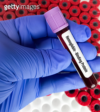 Blood sample tube with sample for Hemoglobin binding protein test ...