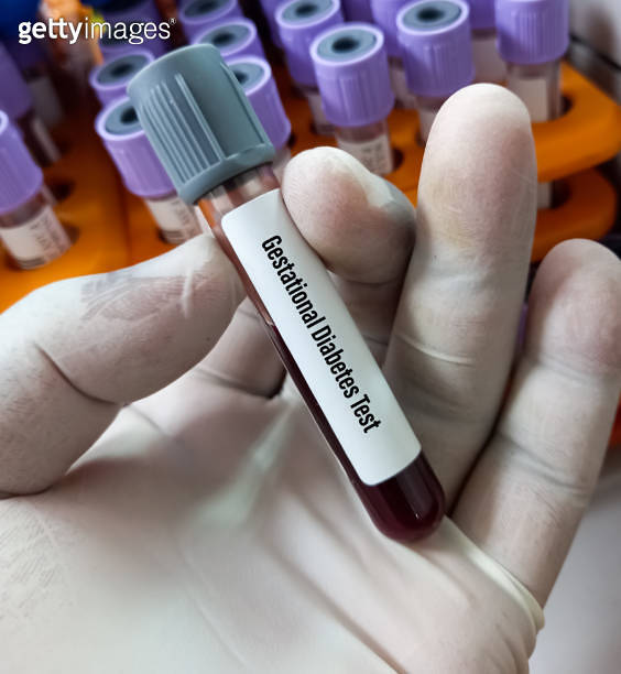 Technologist hold sample tube of Gestational Diabetes Mellitus(GDM ...
